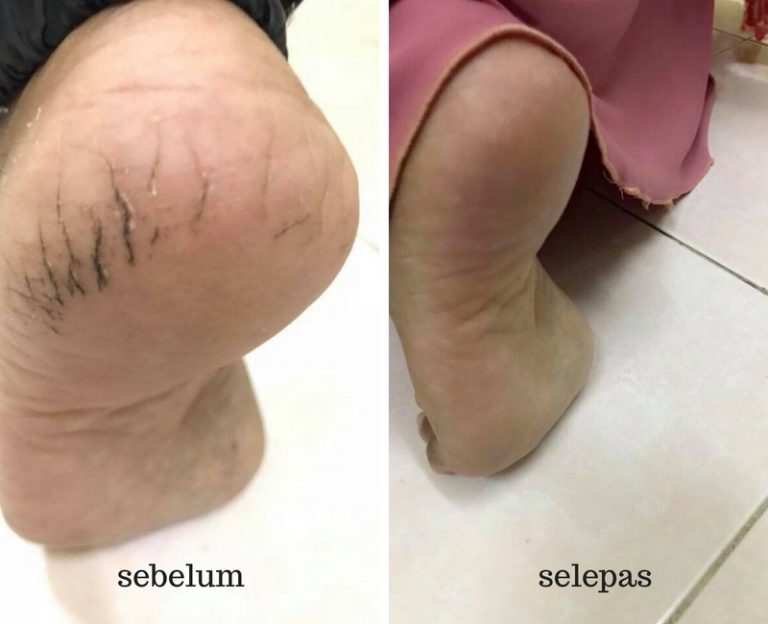 Skrub Kunyit Licinkan Kulit & Berseri. Cara Mudah Ibu2 Perlu Cuba ...