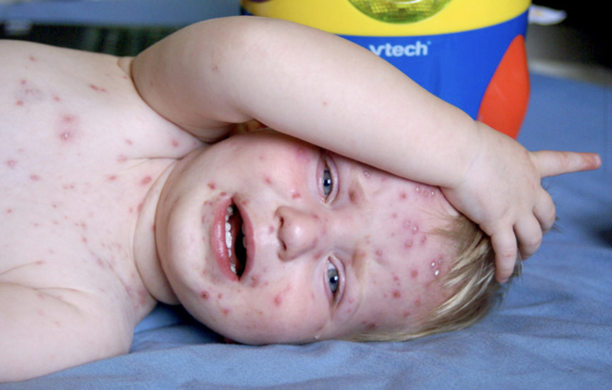 Bila Anak Kena Chicken Pox, Ikut Nasihat Pemakanan Oleh Doktor Ini.