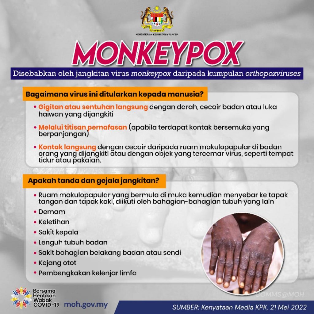KKM Beri Amaran Penularan Wabak Monkeypox, Dah Merebak Beberapa Buah ...