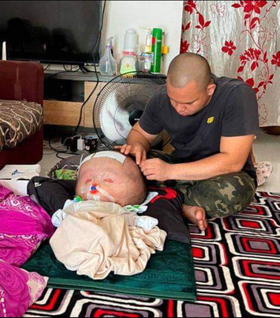 Doakan Bilal. Anak Ni Tanggung Derita Kepala Membesar Seberat 28kg!