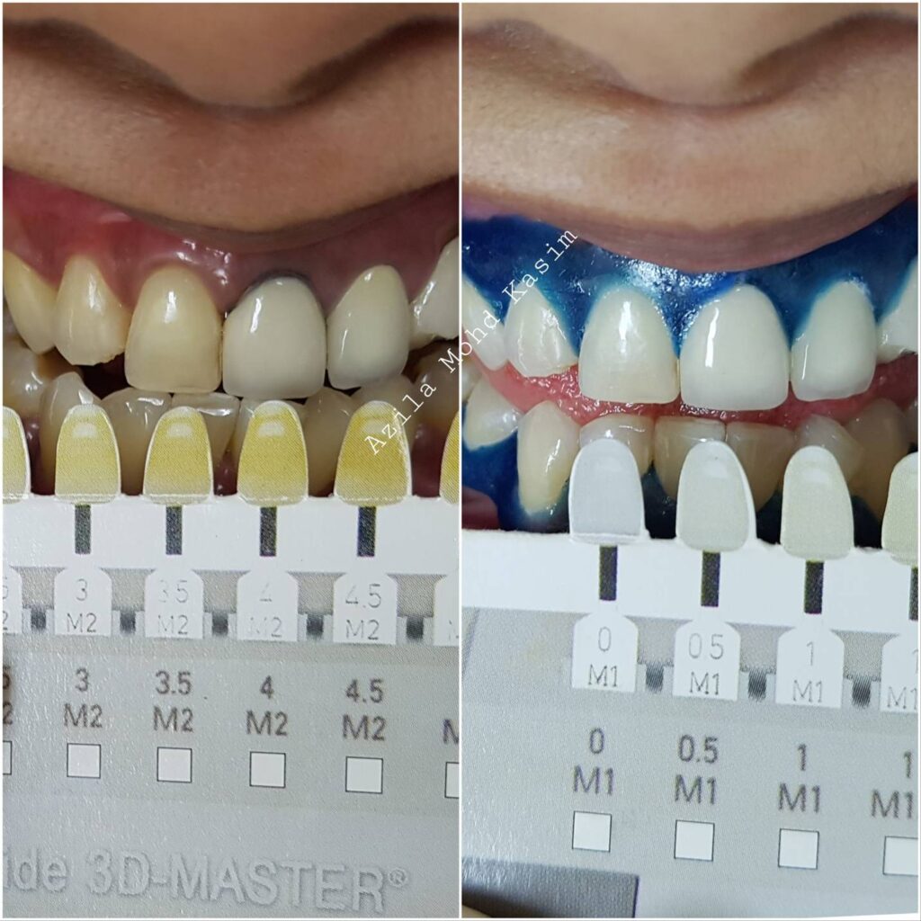 Doktor Kongsi Fakta Mitos Atau Benar, Ubat Gigi Sumber Arang Boleh ...